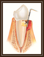 Periodontal Disease Treatment in Walla Walla, WA - Walla Walla ...